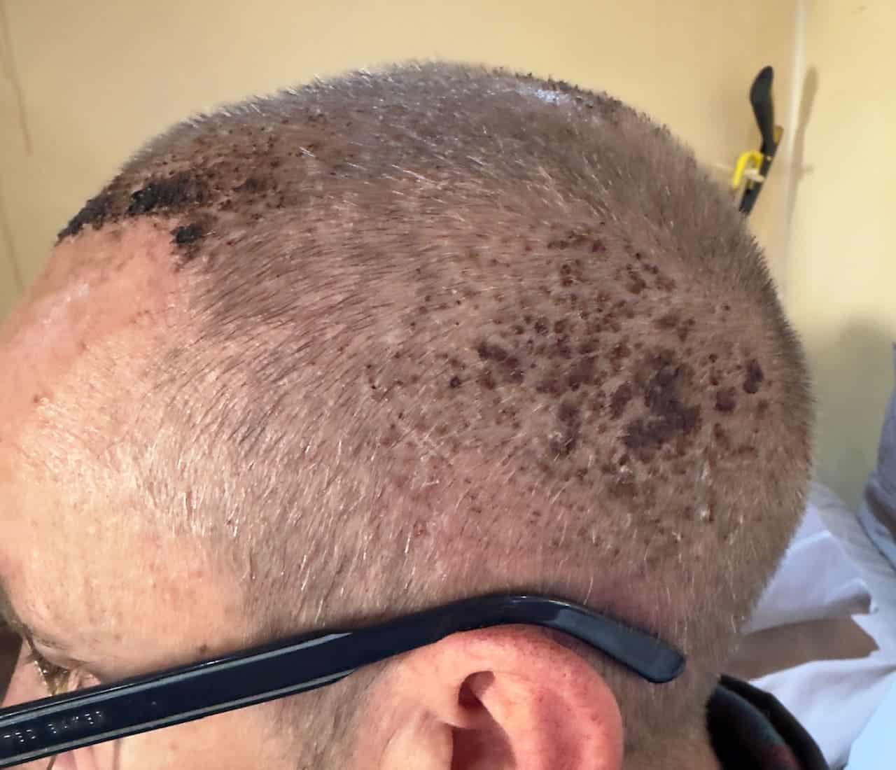Hair Transplant Scabs - How Do I Deal With Them