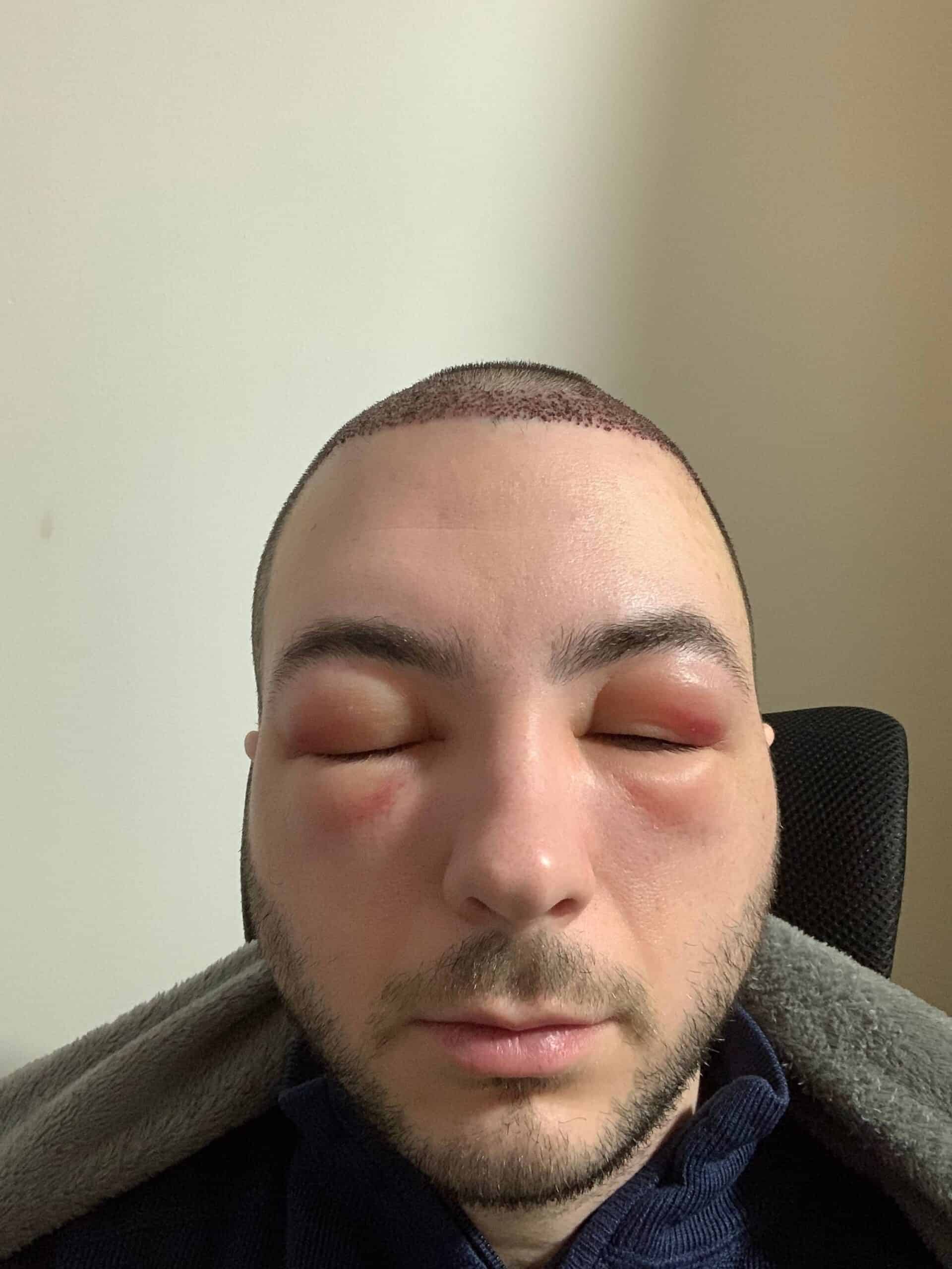 Hair Transplant Swelling - How To Reduce an Oedema