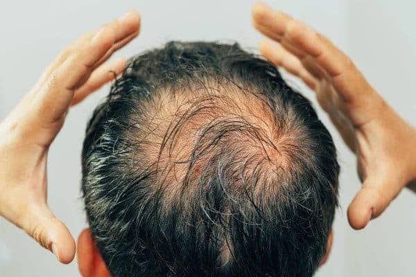 How to Spot and Stop Balding on Crown - Harley Street HTC